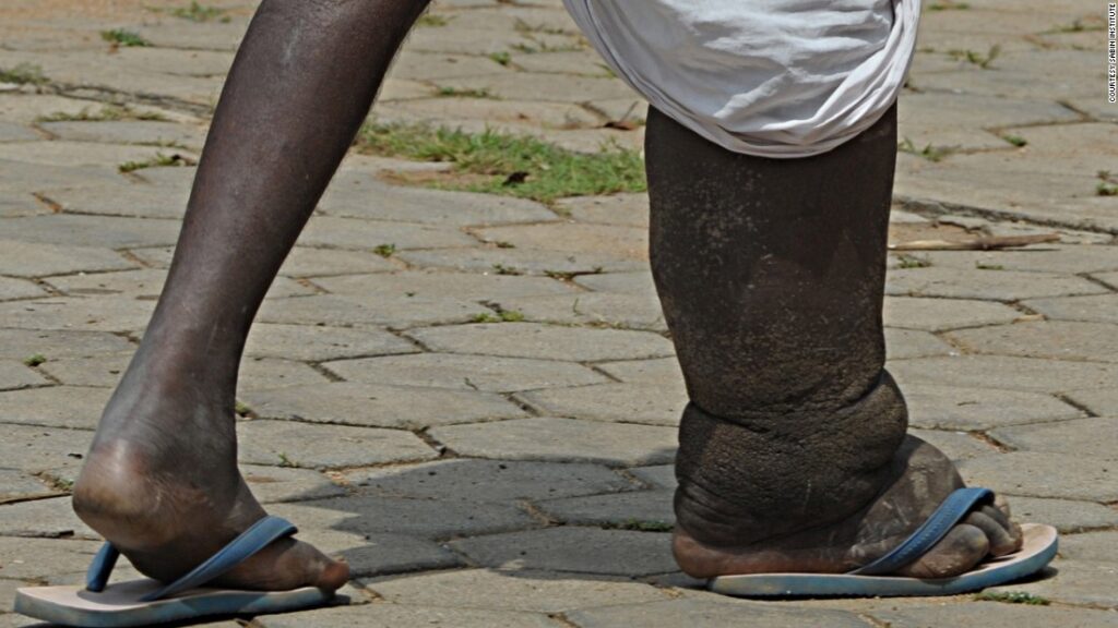 What is elephantiasis and its Causes?